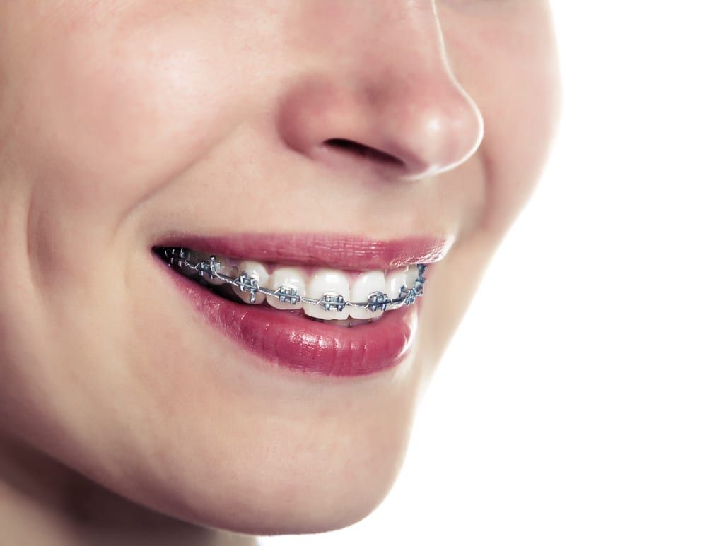 Orthodontics & Invisalign » Santa Ana, CA - Sunset Dental Group